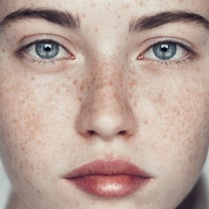 The Truth About All Your Freckles - ZergNet