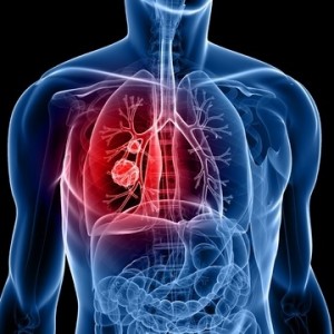 The Deadly Cancer That Grows for Two Decades - ZergNet